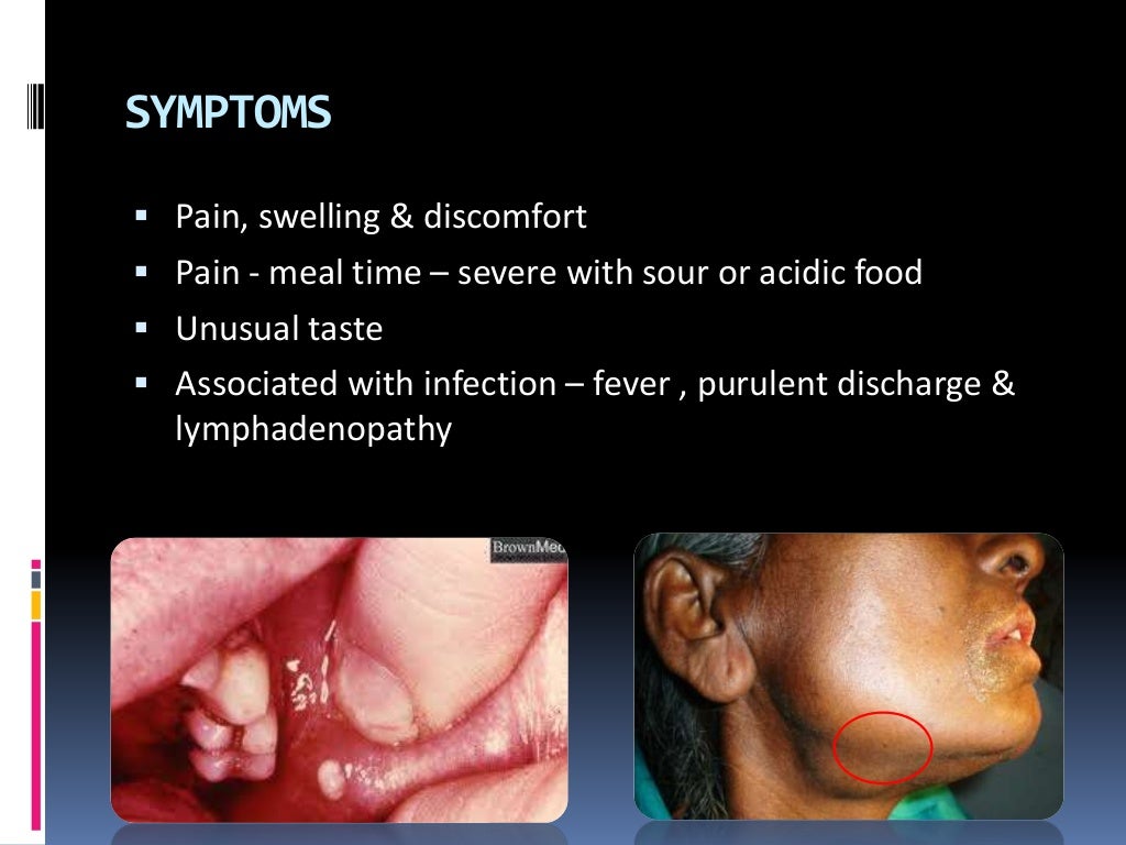 Sialolithiasis and its management in oral and maxillofacial surgery