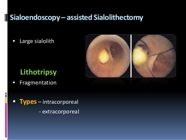 Sialolithiasis and its management in oral and maxillofacial surgery