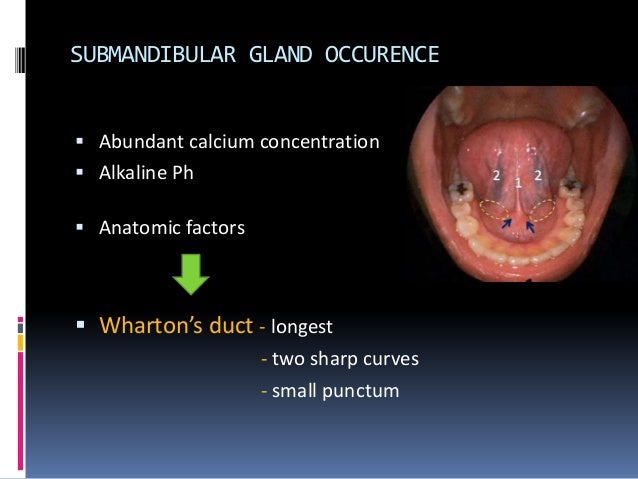 Sialolithiasis and its management in oral and maxillofacial surgery