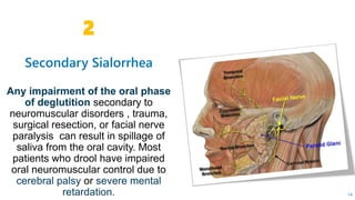 Sialorrhea.pptx