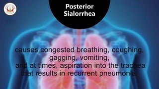 Sialorrhea.pptx