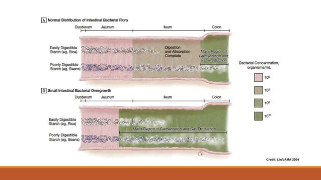 Small Intestinal Bacterial Overgrowth (SIBO) | PPTX