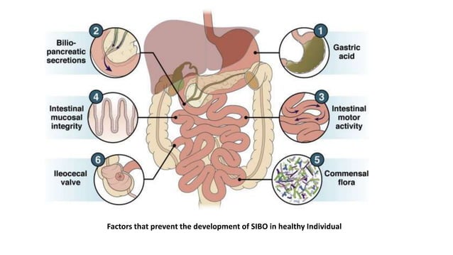 Small Intestine Bacterial Overgrowth (SIBO) | PPTX | Digestive ...