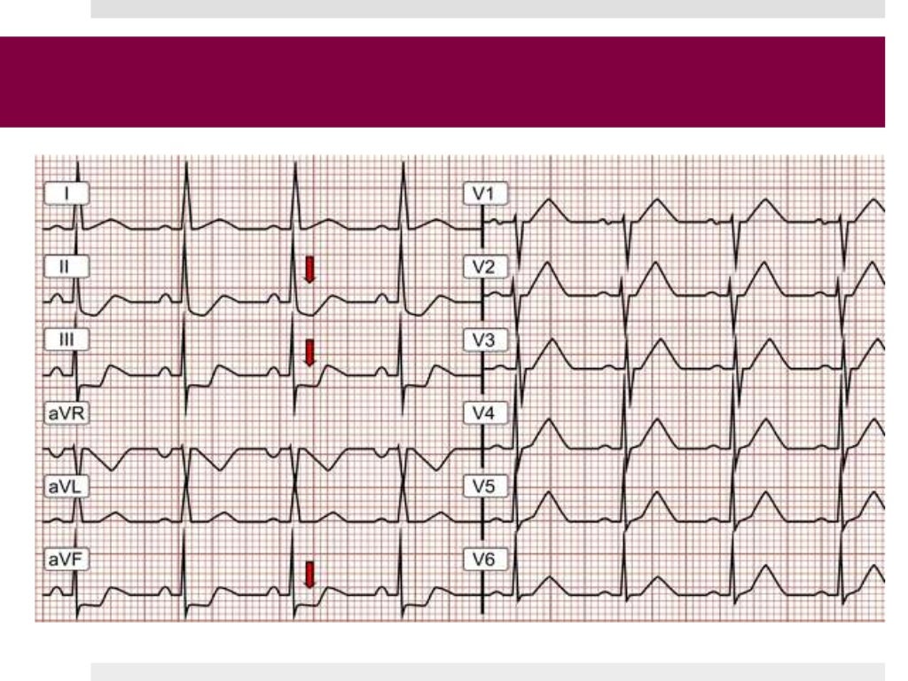 IAM sin elevación del segmento ST