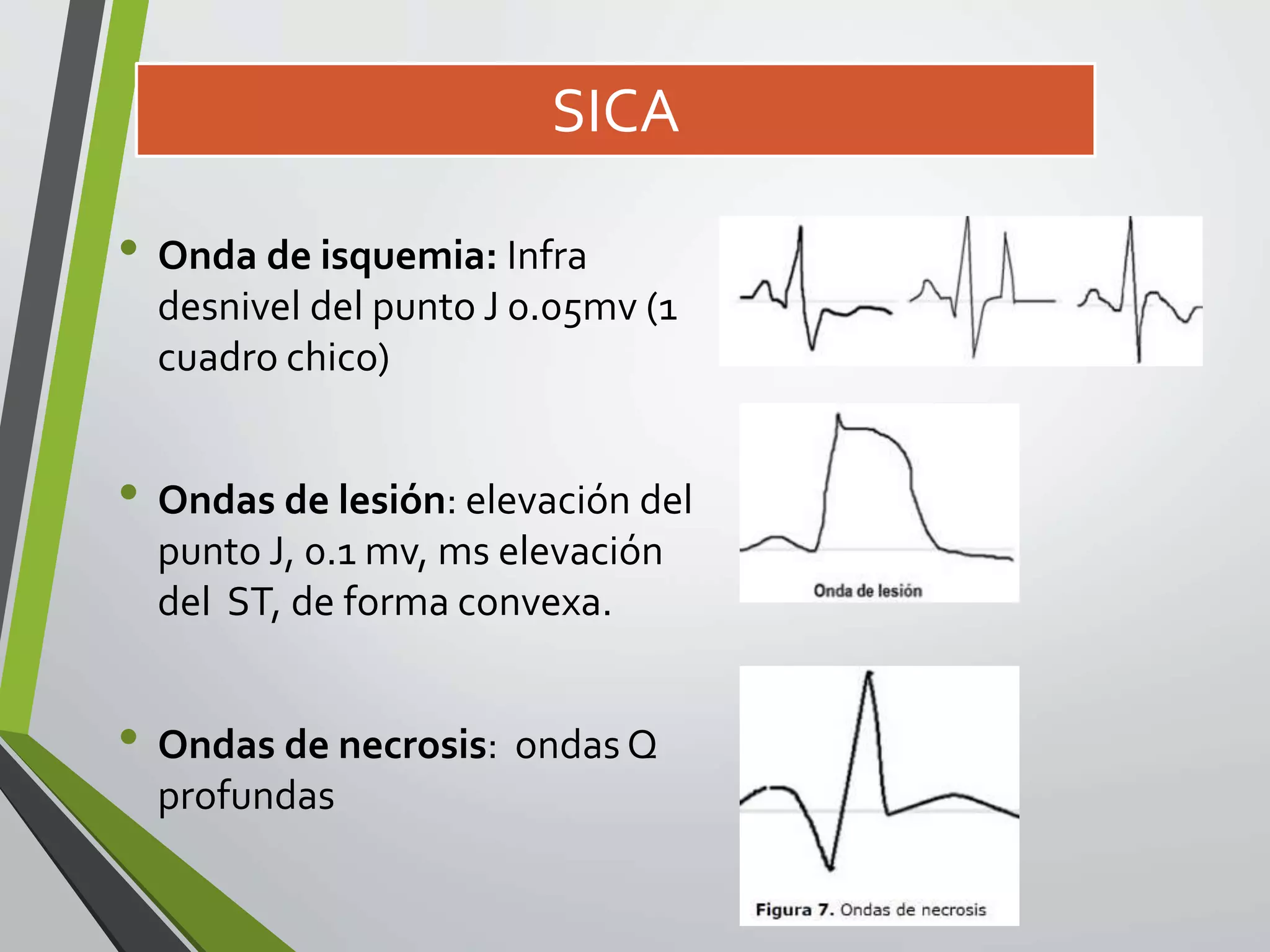 SICA- SINDROME ISQUEMICO CORONARIO AGUDO | PPTX