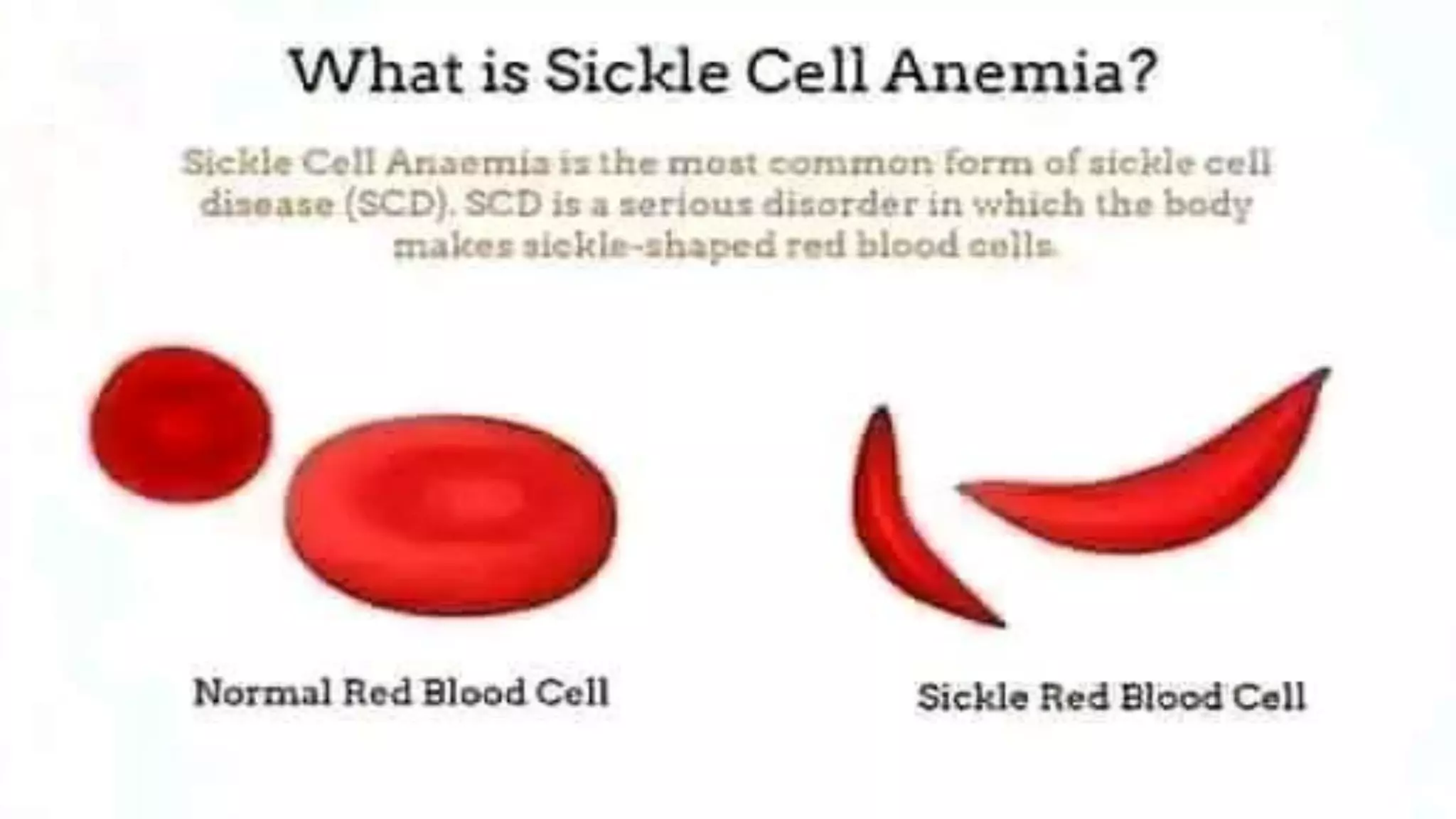 SICKEL CELL ANEMIA Slideshow | PPTX