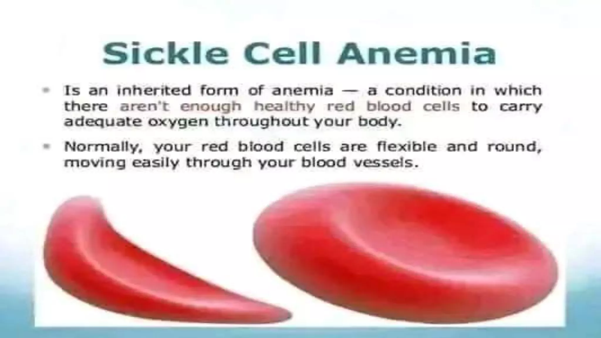 SICKEL CELL ANEMIA Slideshow | PPTX