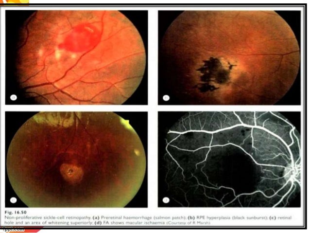 Sickle Cell Retinopathy