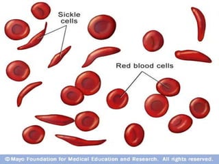 sickle cell | PPT