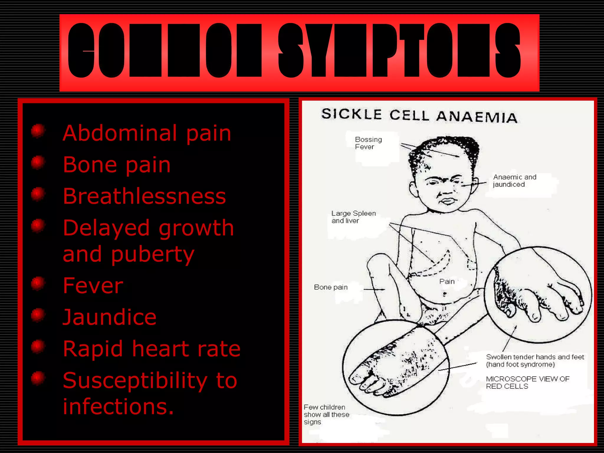Sickle Cell Anemia | PPT | Blood Disorders | Diseases and Conditions