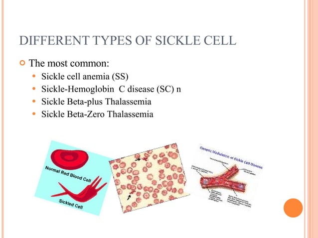 Student Work Sickle Cell | PPT