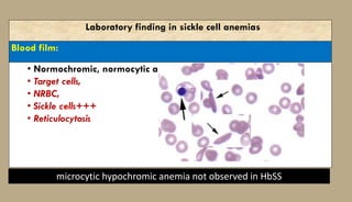 Sickle cell diseases (SCD) | PDF