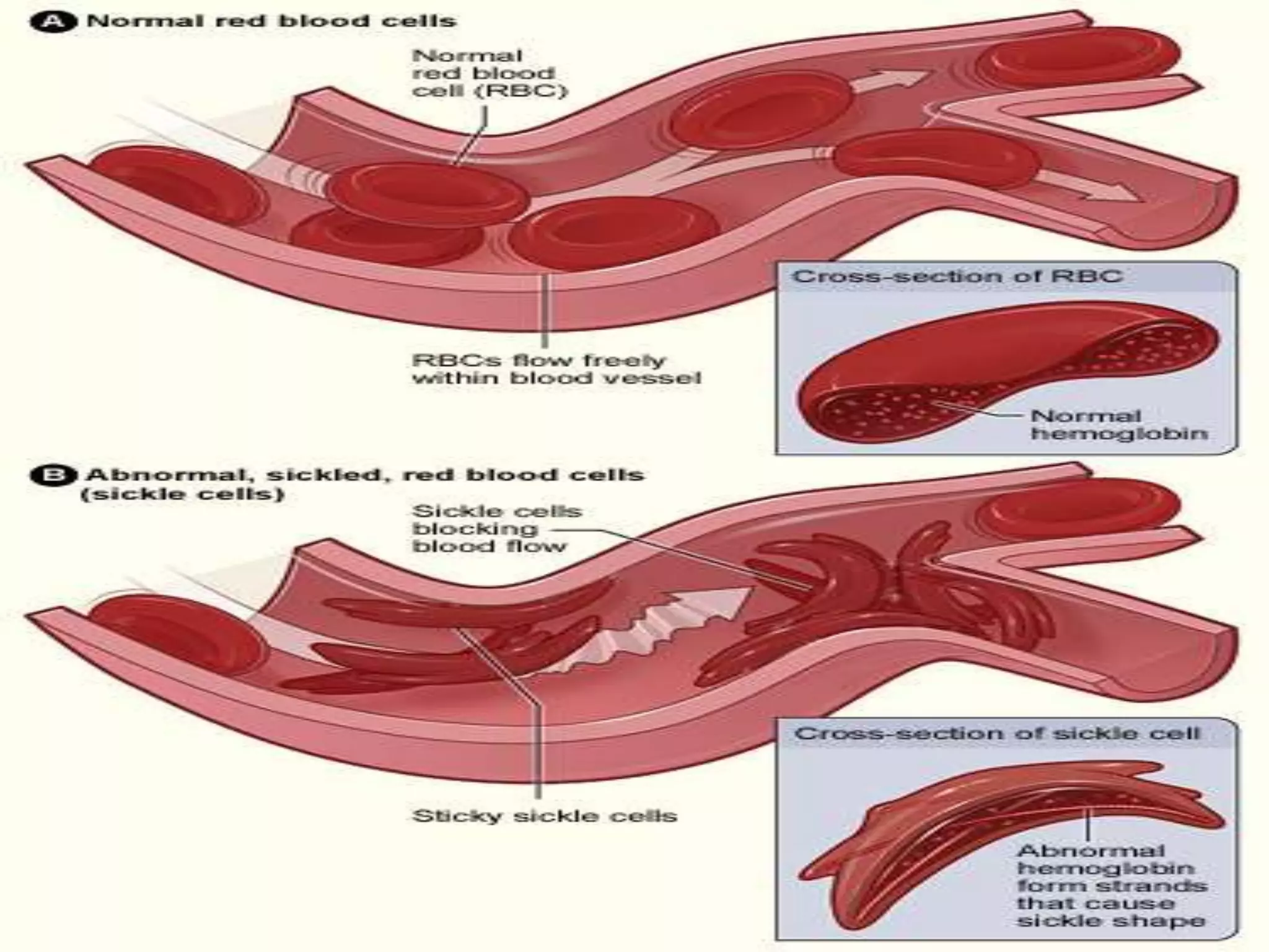 Sickle cell anemia | PPTX