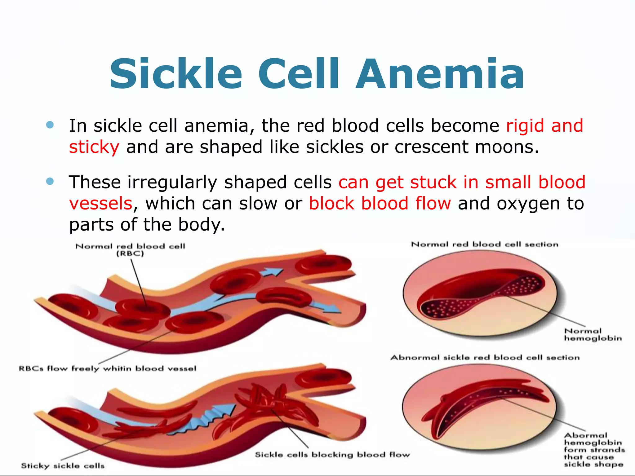 Sickle cell anemia | PPTX | Blood Disorders | Diseases and Conditions