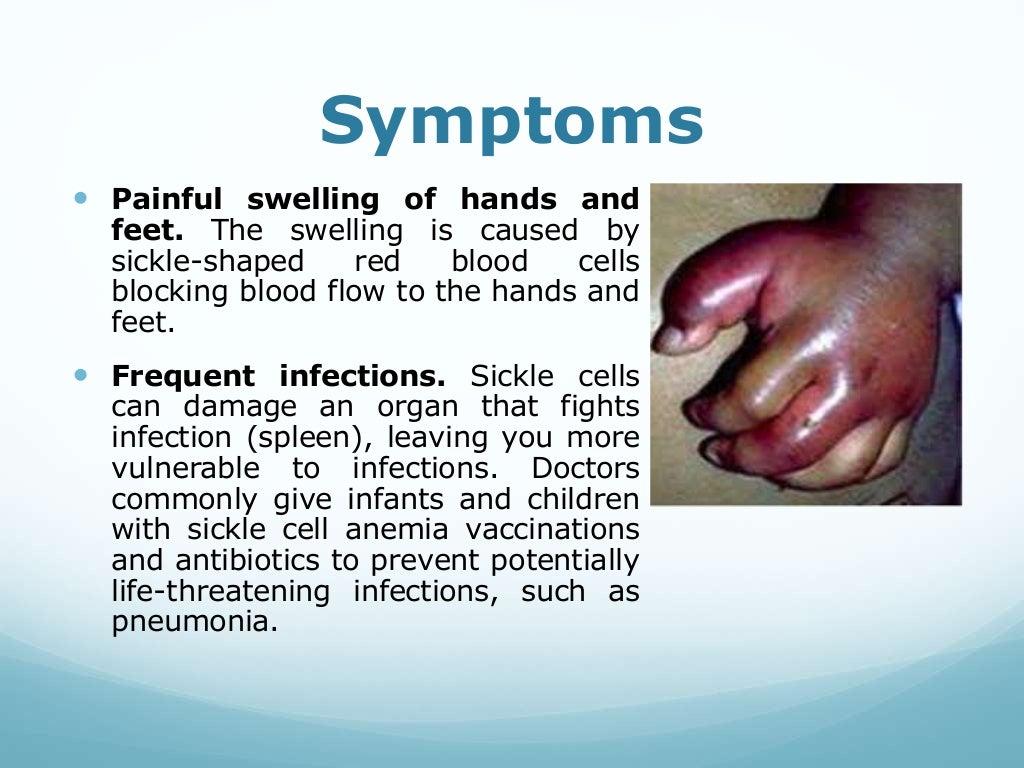 Sickle cell anemia