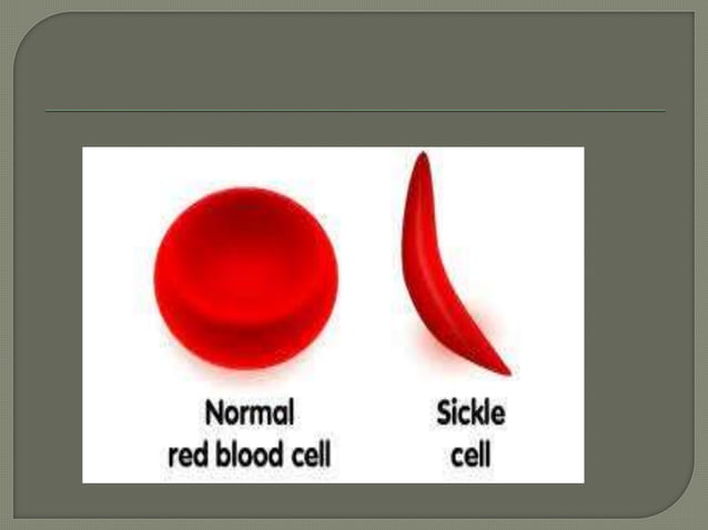 SICKLE CELL PATHOPHYSIOLOGY B.PHARM 2ND SEM.pptx | Blood Disorders | Diseases and Conditions