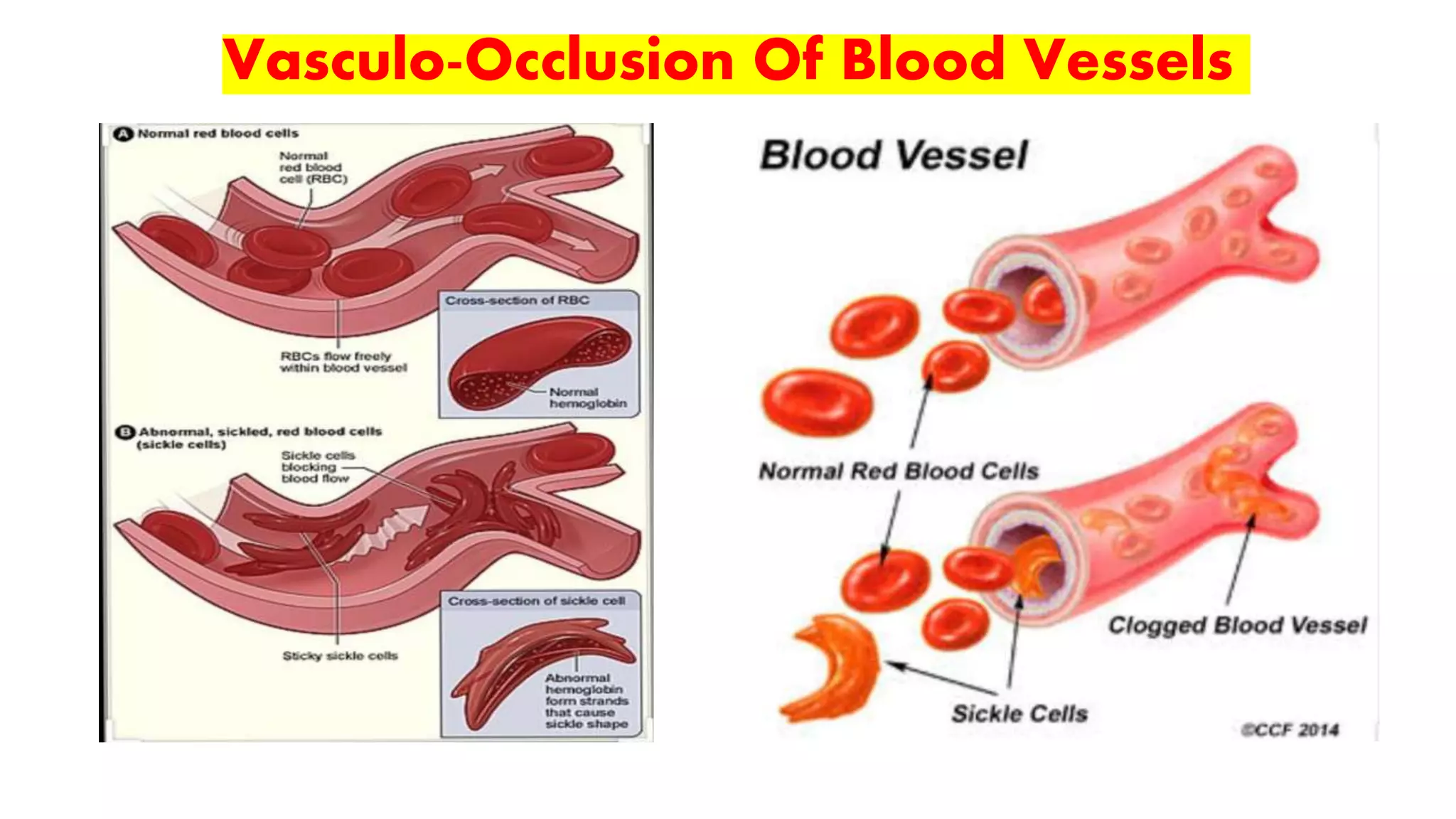 Sickle cell anaemia | PPTX