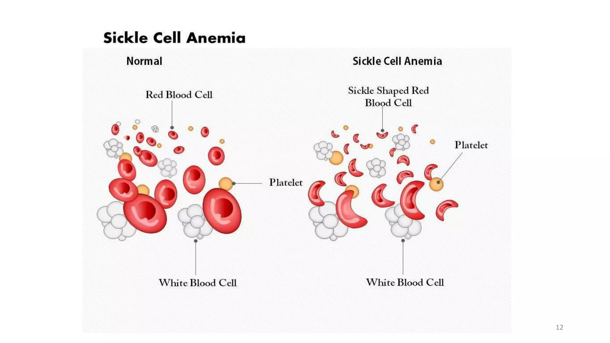 Sickle cell anaemia | PPTX
