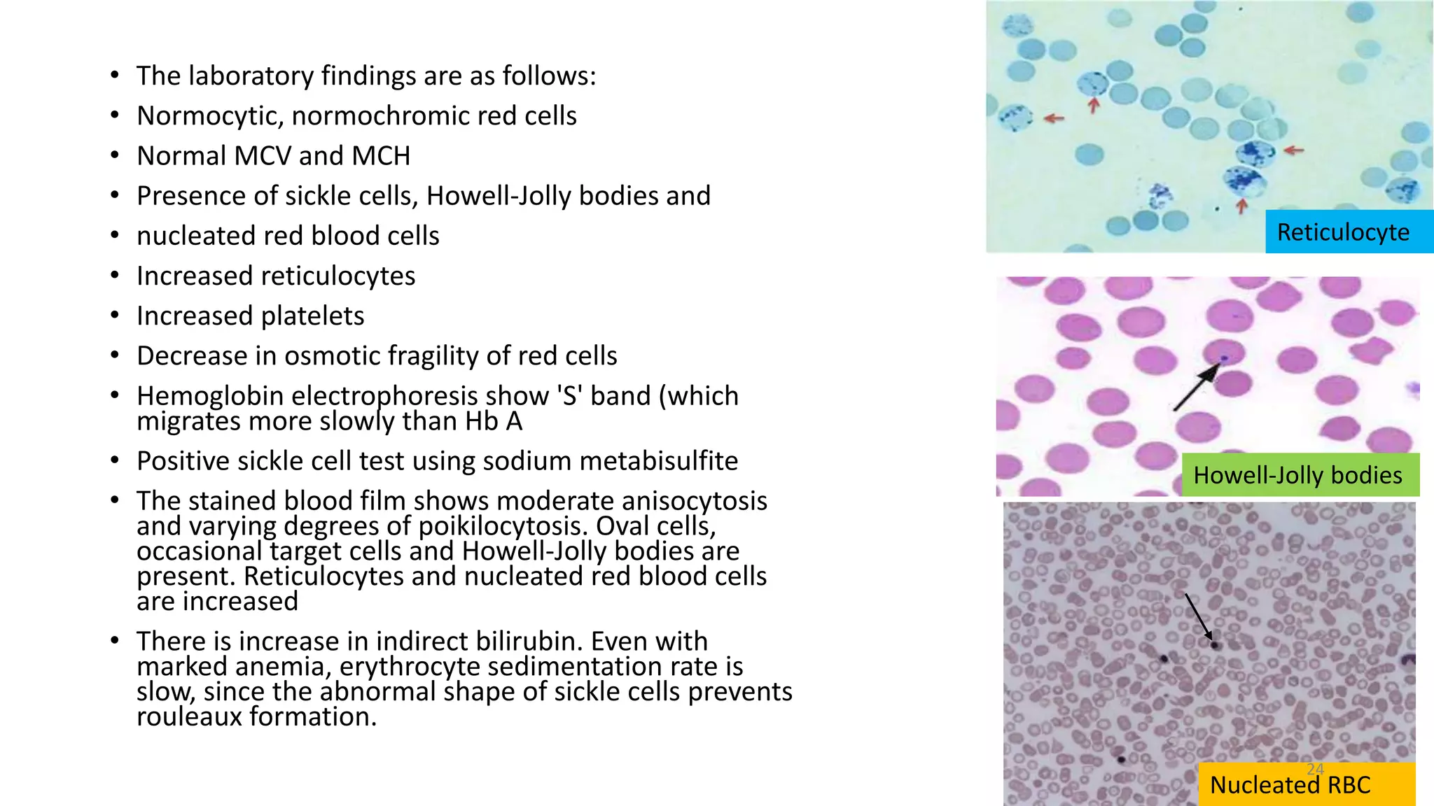 Sickle cell anaemia | PPTX