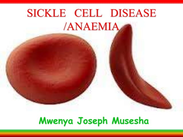 SICKLE CELL ANAEMIA ,TYPES AND MANAGEMENT | PPT