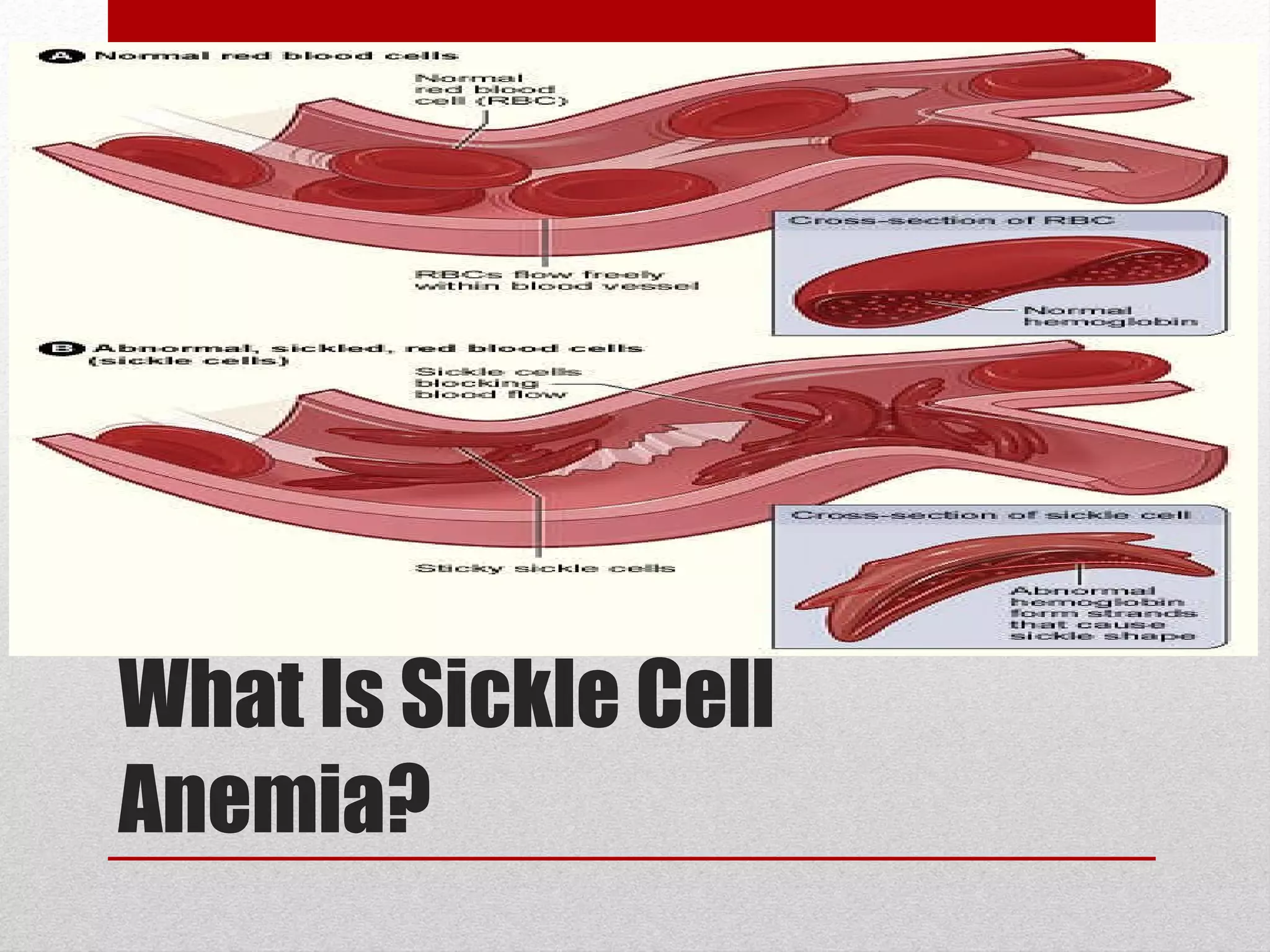 Sickle Cell Anemia | PPT