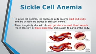 Sickle Cell Anemia with pathophysiology and explanation | PPTX