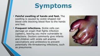 Sickle Cell Anemia with pathophysiology and explanation | PPTX