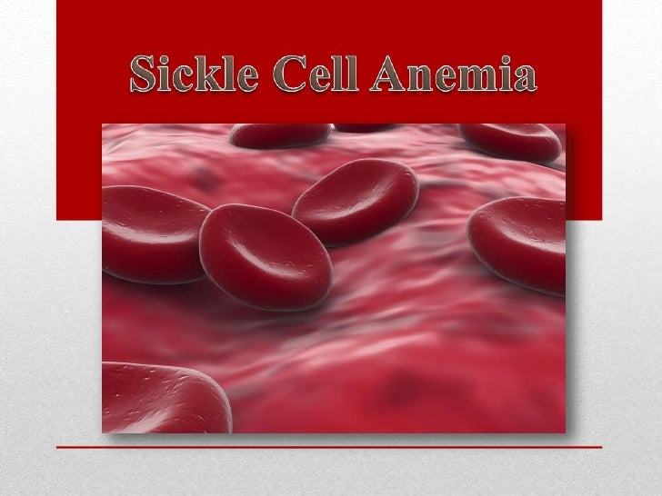 Sickle Cell Anemia Sickle Cell Anemia