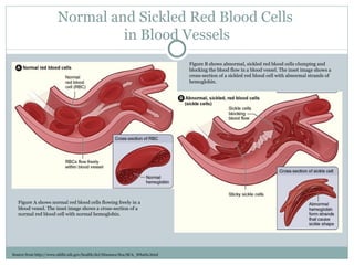 Sickle cell anemia | PPT