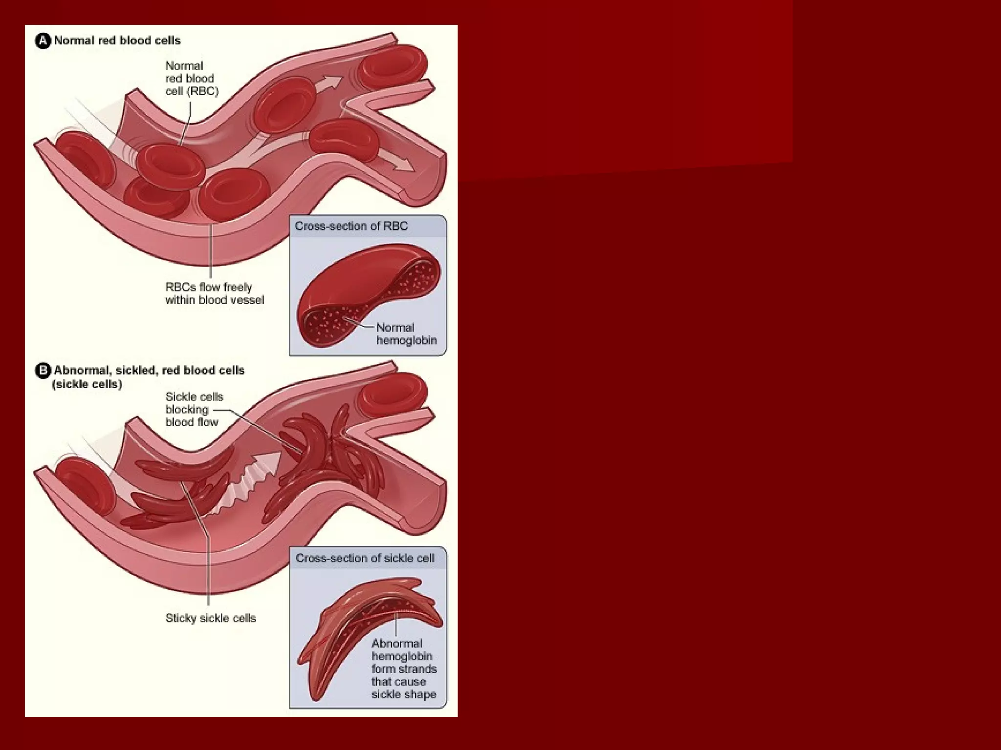 Sickle cell anemia | PPT
