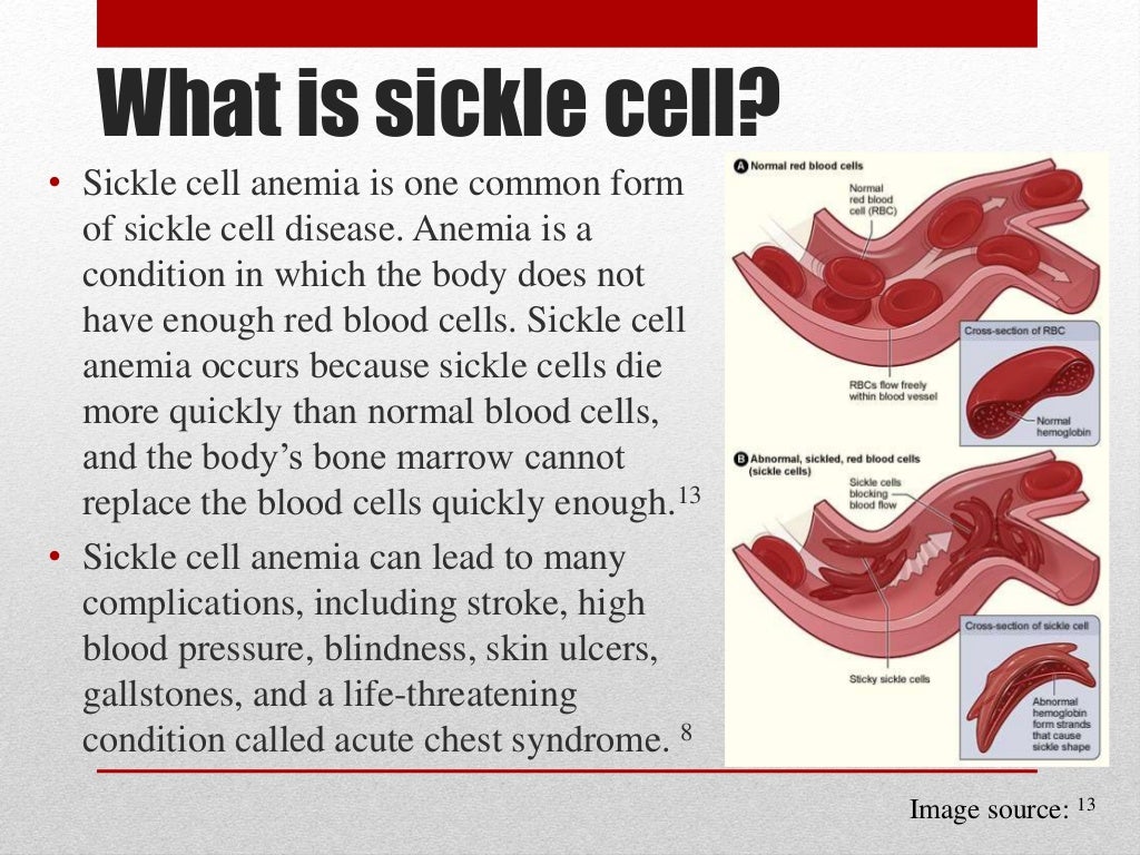 Sickle Cell Anemia