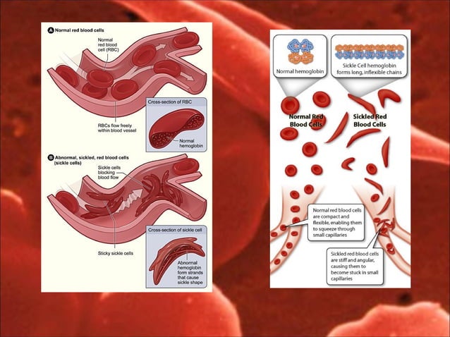 Sickle cell anemia | PPT