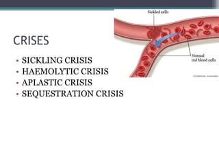 Sickle cell anemia | PPTX