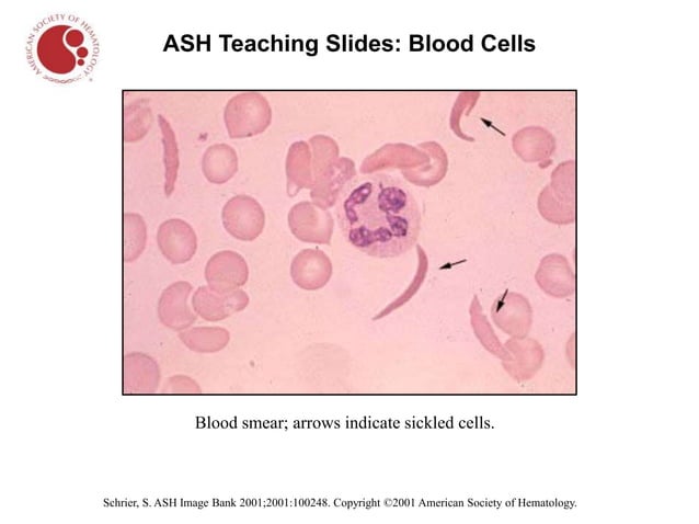 Sickle Cell Anemia (SCA) smear presentation | PPT