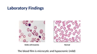 Sickle Cell Anemia.pptxSickle Cell Anemia | PPTX