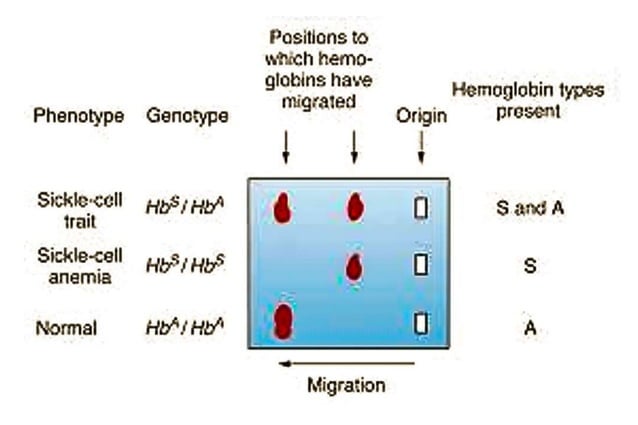 Sickle cell anemia | Hemoglobinopathies | PPT