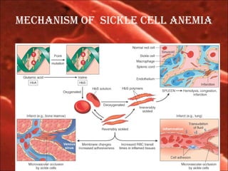 Sickle cell anemia - By Janaki raman | PPT