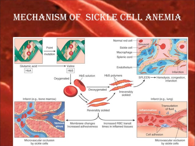 Sickle cell anemia - By Janaki raman | PPT | Blood Disorders | Diseases ...