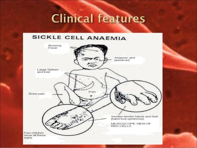 Sickle cell anemia - By Janaki raman