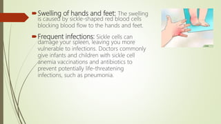 Sickle cell Anemia- symptoms.pptx