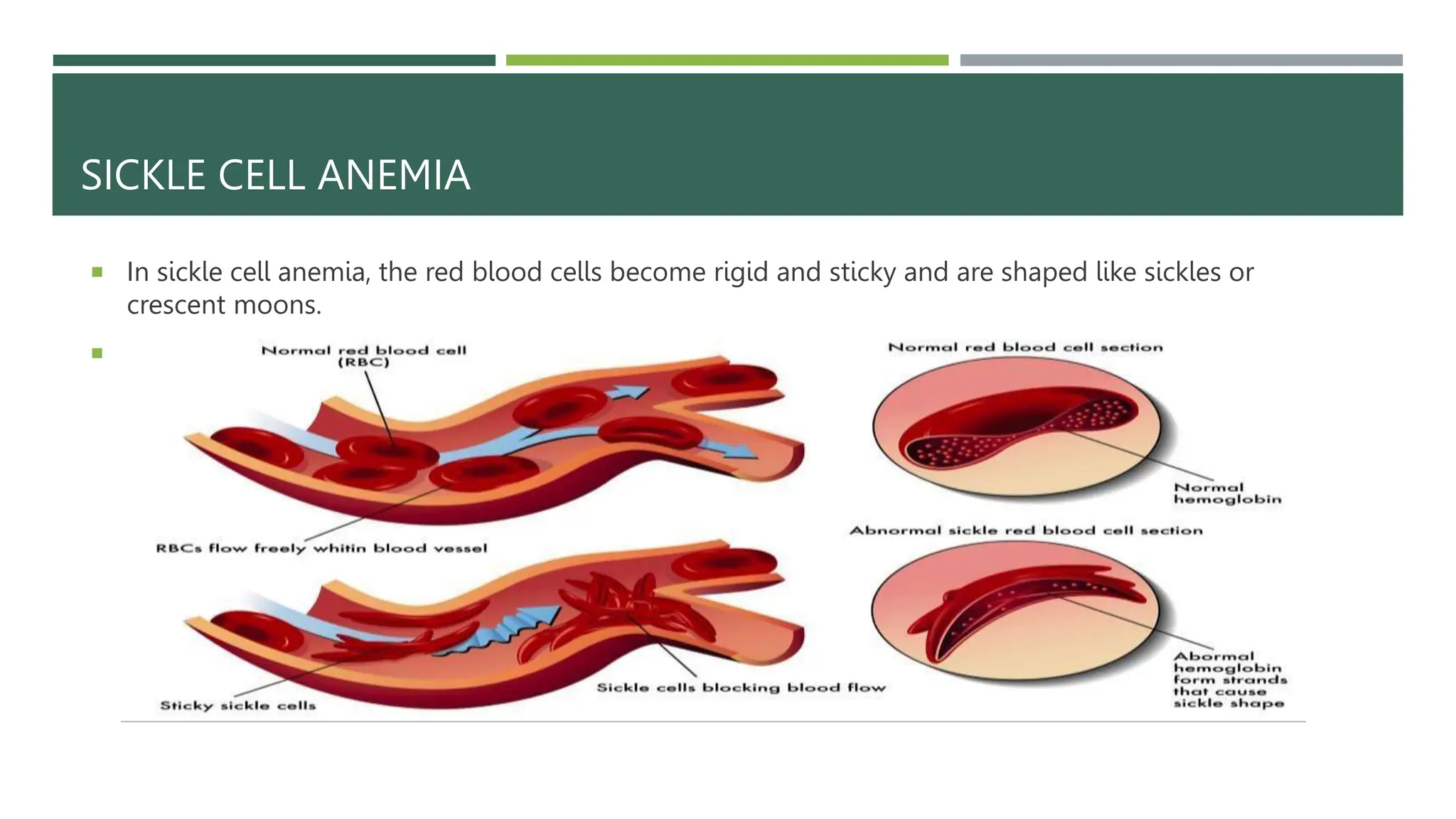 pediatrics 6. Sickle Cell Anemia 6.1.pptx