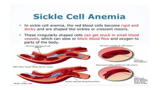 sickle cell anemia disease.pptx anemia disorder | PPTX