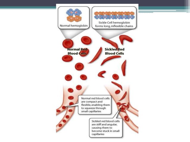Sickle cell anemia