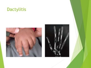 Sickle cell disease | PPTX