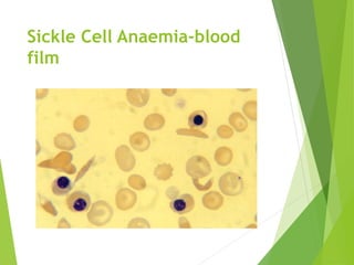 Sickle cell disease | PPTX