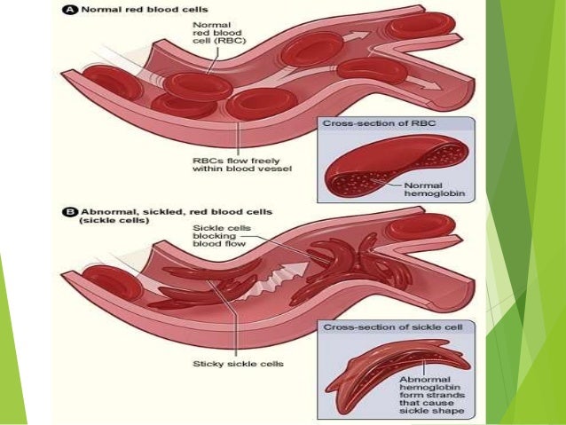 Sickle cell disease