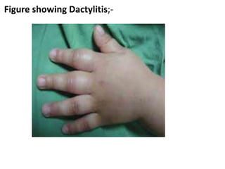 Sickle cell disease | PPTX