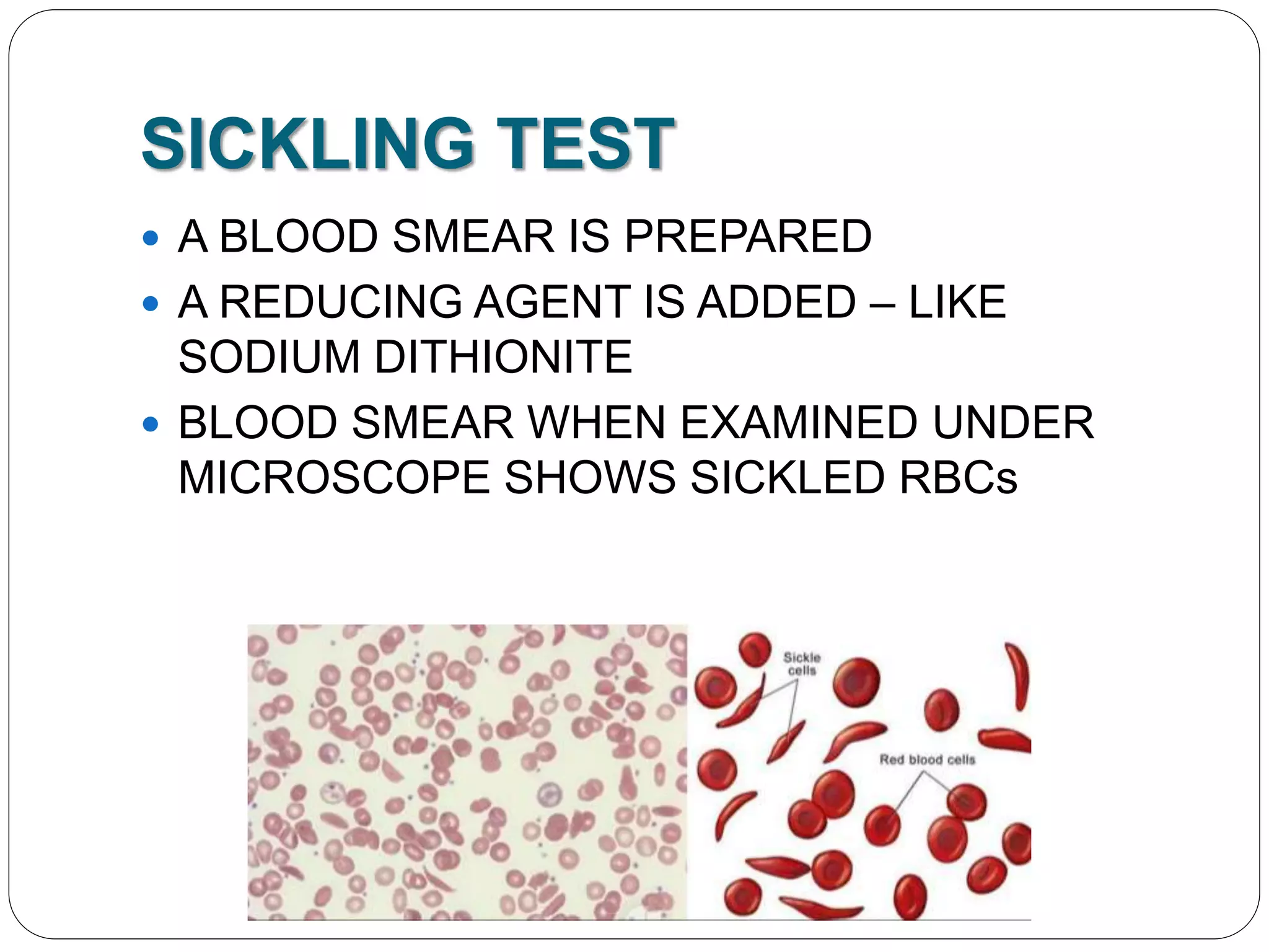 Sickle Cell Disease | PPT