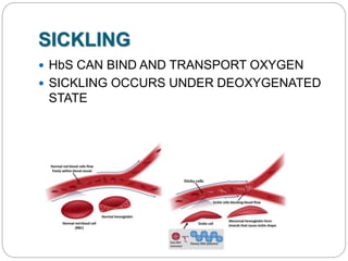 Sickle Cell Disease | PPT