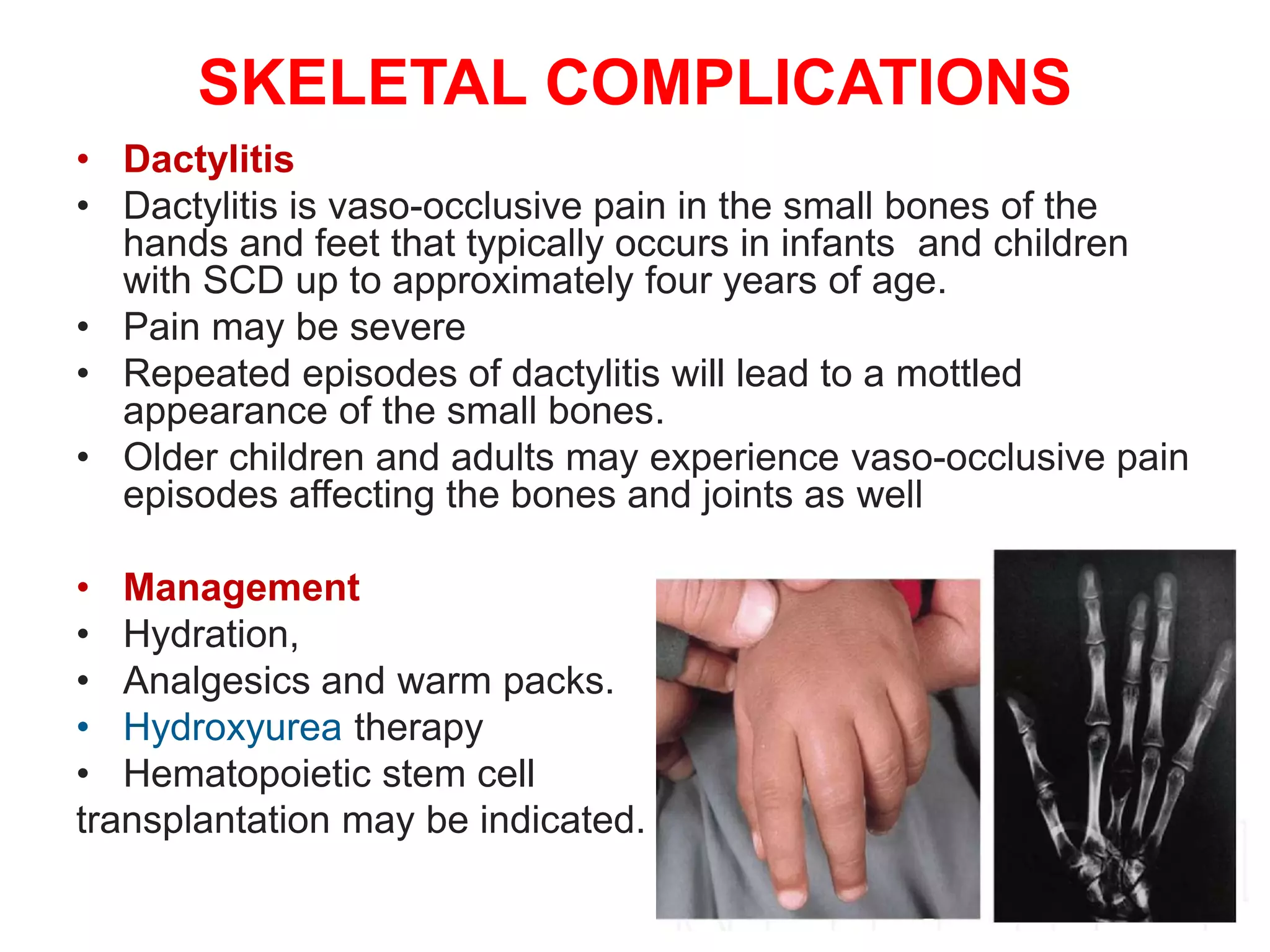 SICKLE CELL DISEASE.pptx